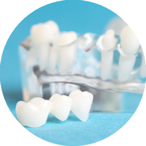 Zirconia Fixed Bridge | Traverse City, MI | Cadillac, MI | Amalfitano ...