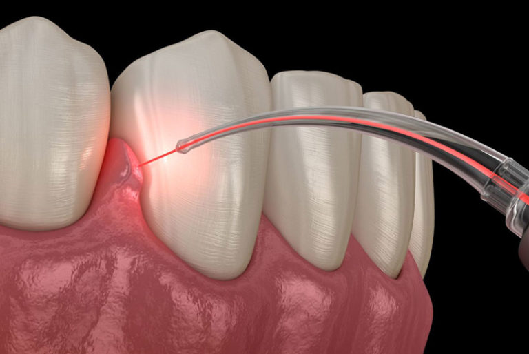 LANAP® | Gum Disease | Traverse City, MI | Cadillac, MI